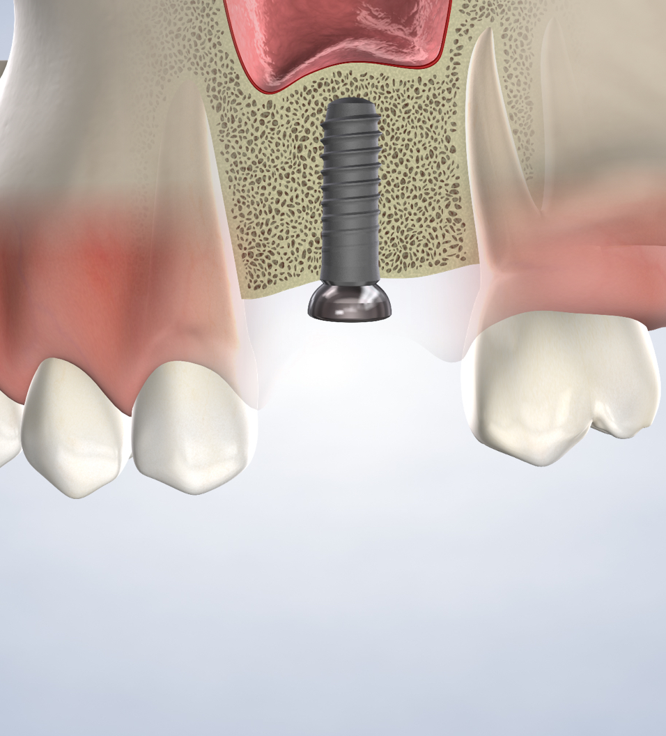 Procedures | Innovative Implant and Oral Surgery