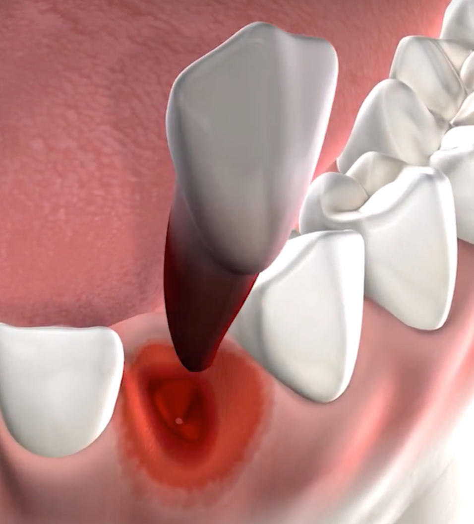 Procedures | Innovative Implant and Oral Surgery
