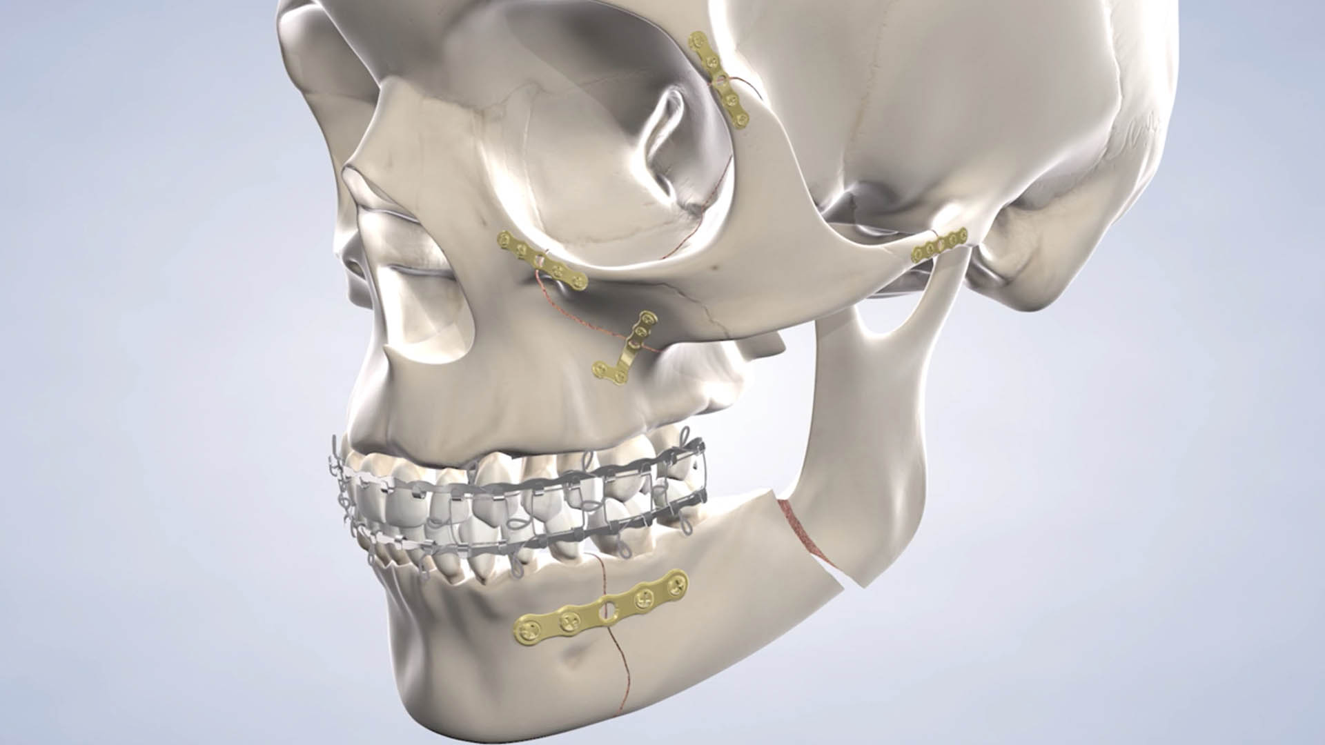 Facial Trauma | Innovative Implant and Oral Surgery
