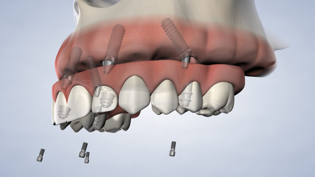 Full-Arch Restoration | Innovative Implant and Oral Surgery