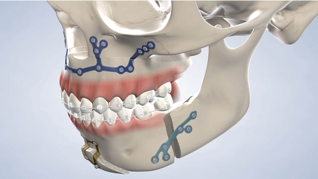 Jaw Augmentation | Innovative Implant and Oral Surgery