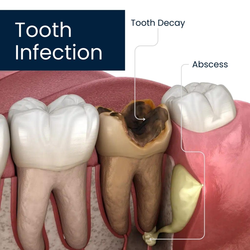 Hidden Tooth Infections Making You Sick | Innovative Implant & Oral Surgery
